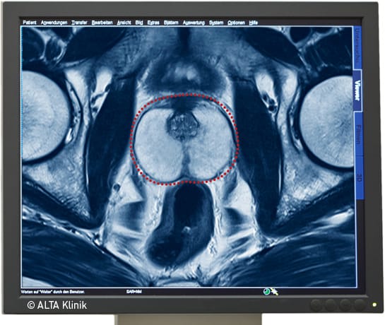 MRT-Untersuchung der Prostata und des gesamten Beckens