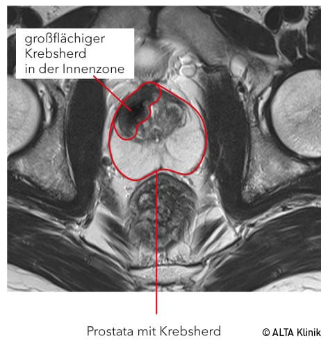 Prostata MRT - die sichere und schmerzfreie Alternative zur Biopsie