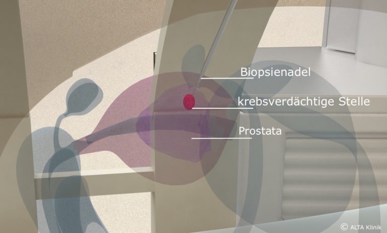Prostatabiopsie: MRT-gesteuerte Alternative zur Stanzbiopsie
