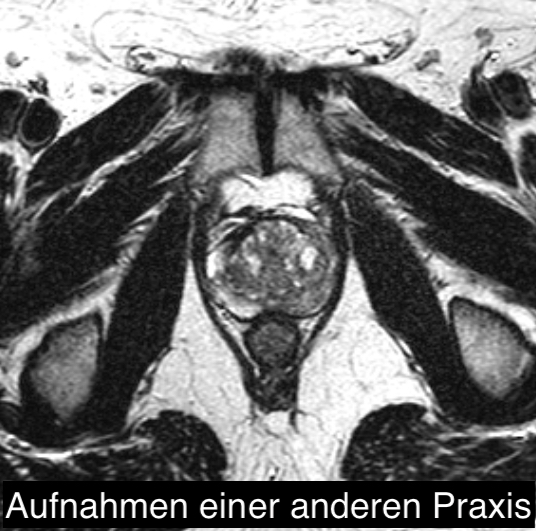Prostata MRT - die sichere und schmerzfreie Alternative zur Biopsie